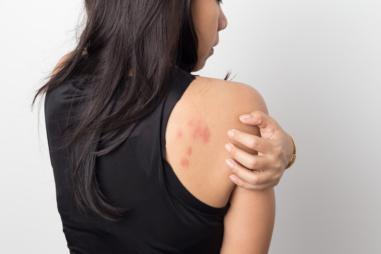 Hives In Black Children